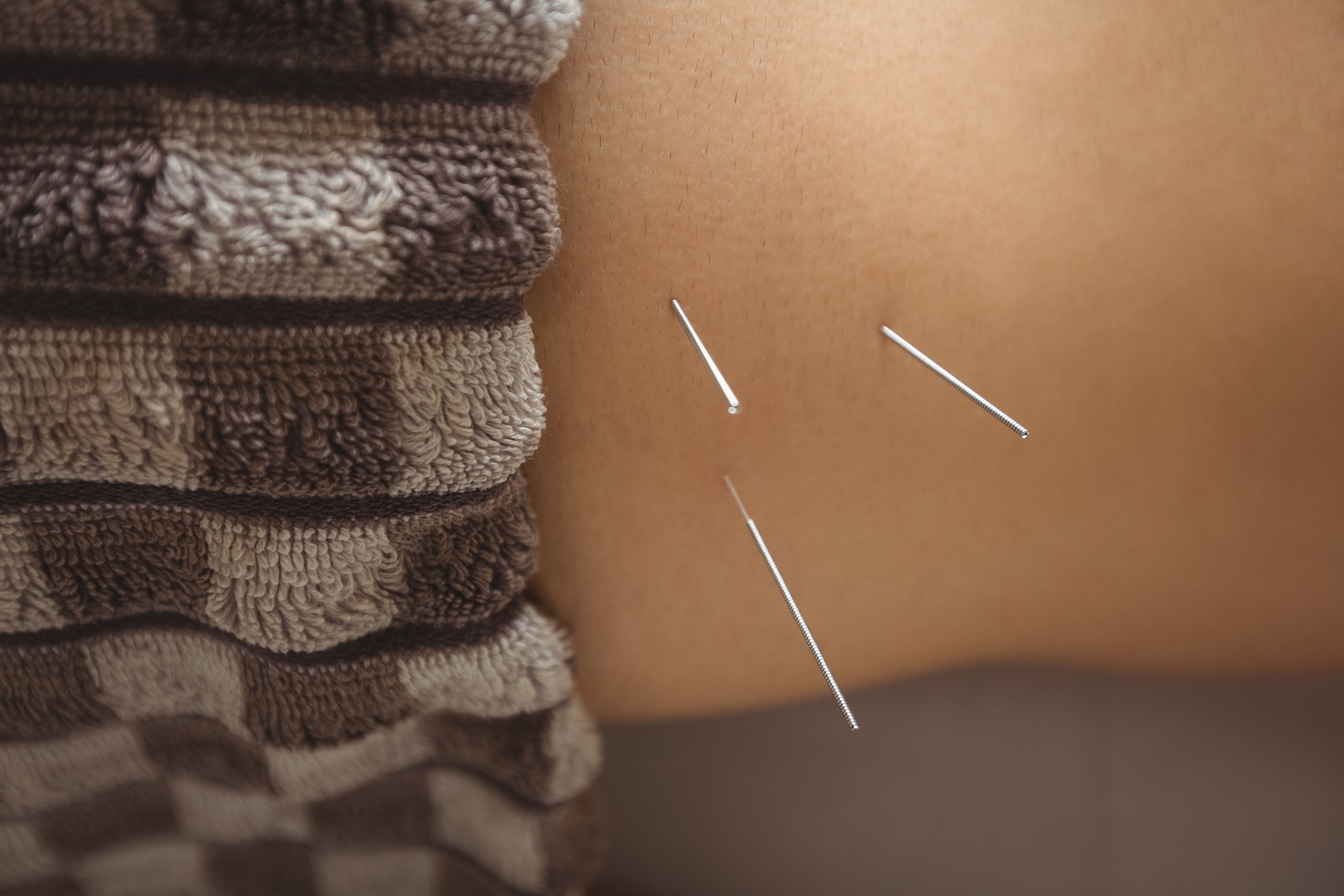 How Does Dry Needling Help Relieve Muscle Pain?